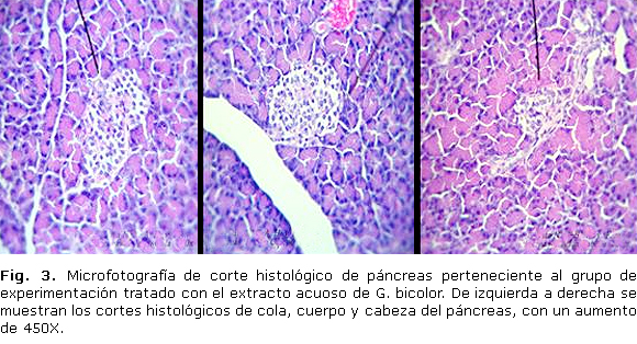 Diabetes Tipo 1 Páncreas Histología